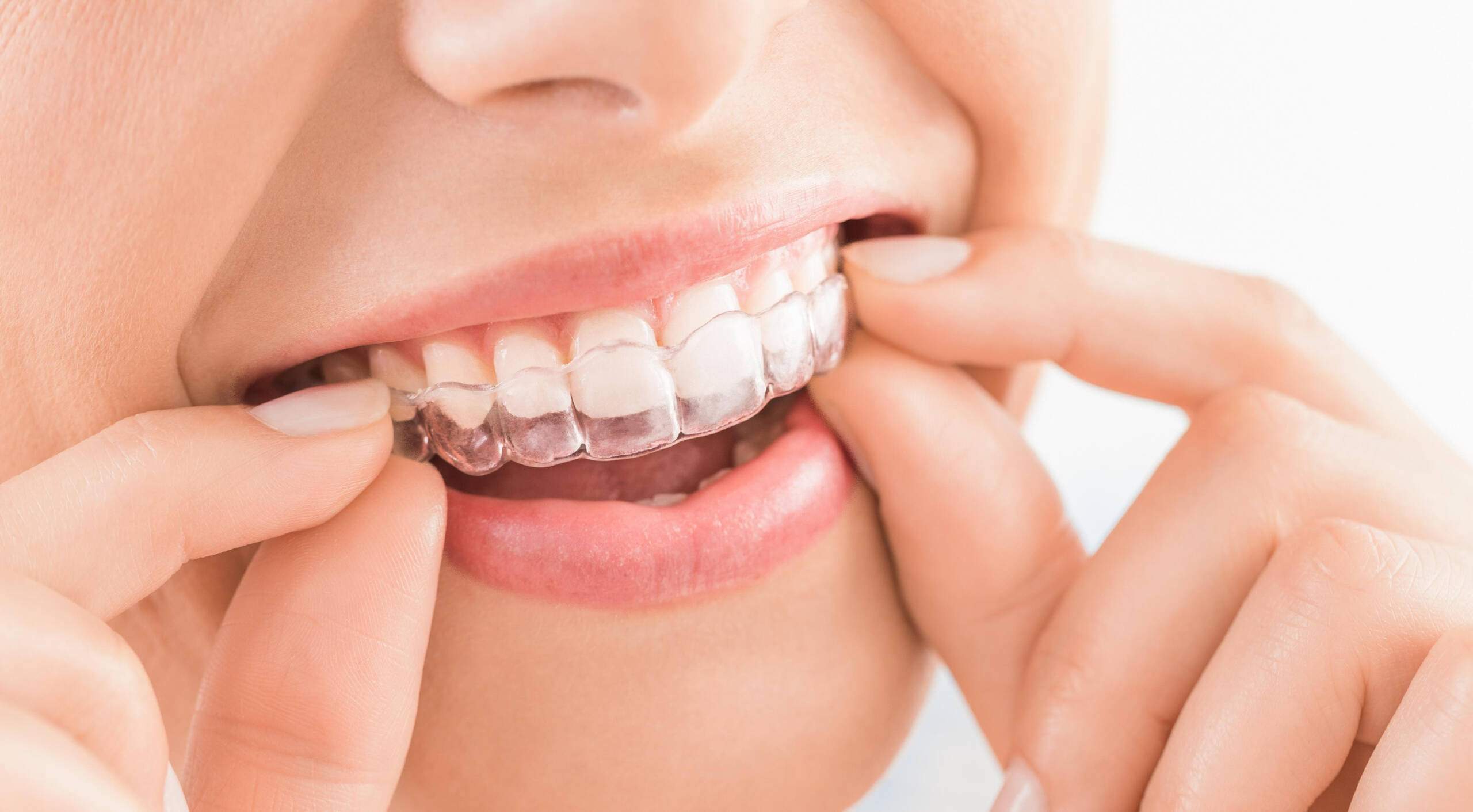 Invisalign Treatment In Kochi Clear Aligners Dental Point